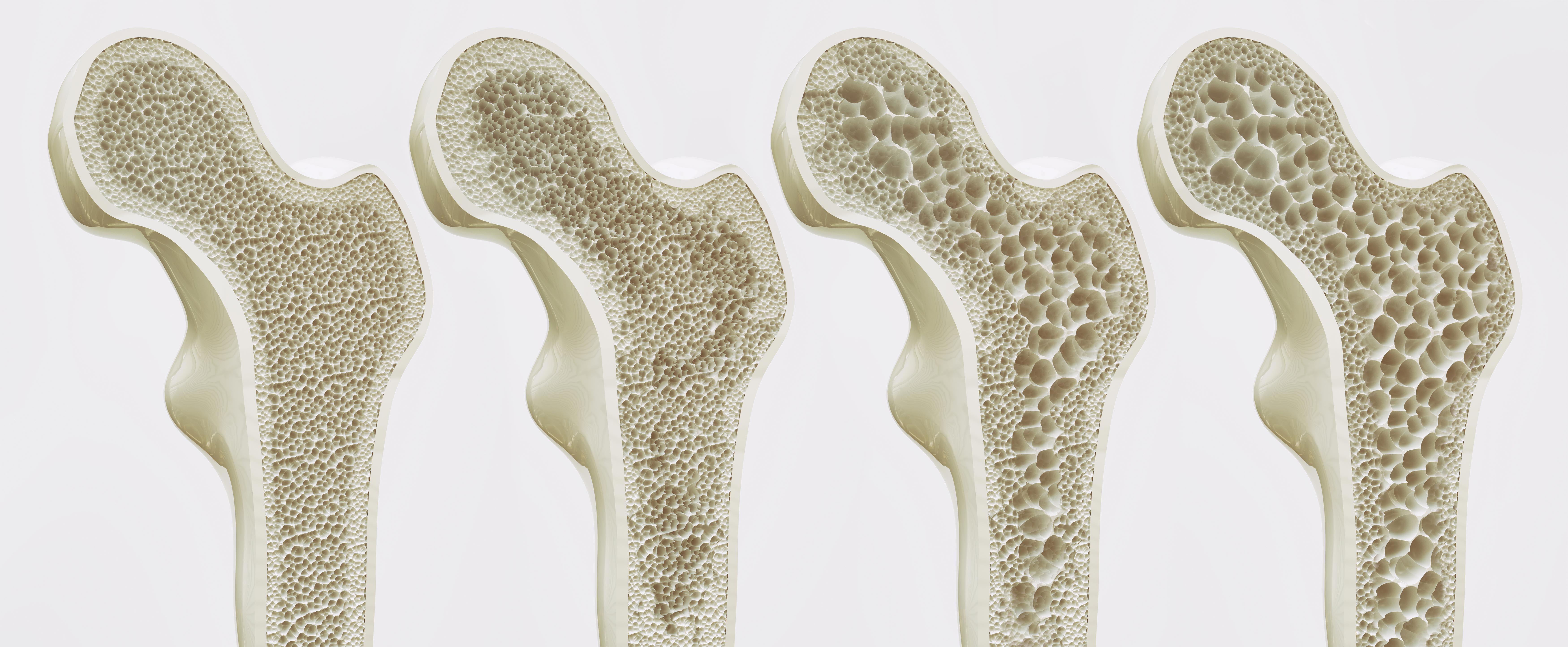 Osteoporosis Osteoporosis